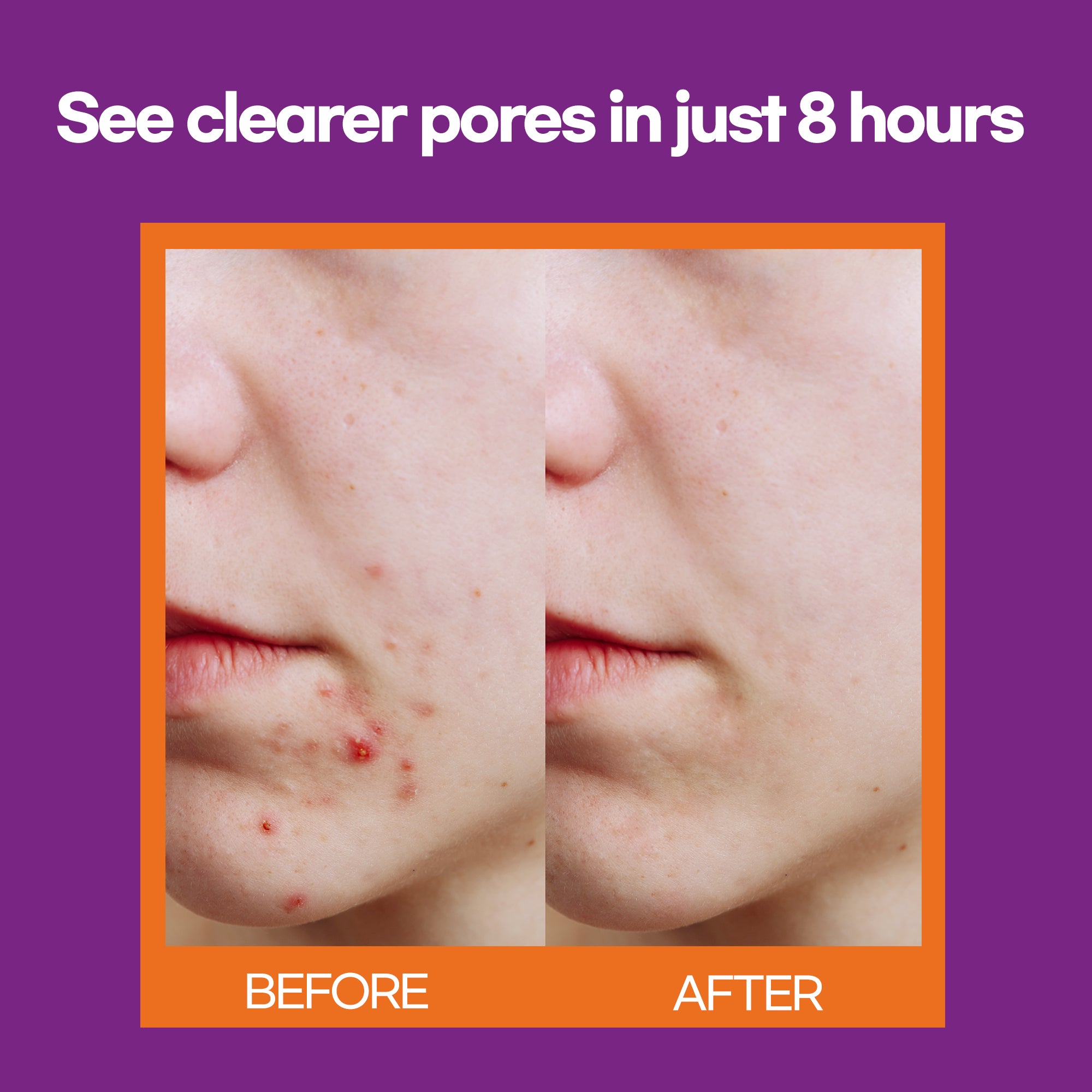 Acne Patch Shapes (Halloween) | 75 Patches | Infused with Tea Tree Oil ...